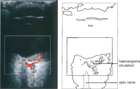 Secondary Glaucoma Clinical Gate
