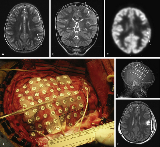 Mapping Disconnection And Resective Surgery In Pediatric Epilepsy