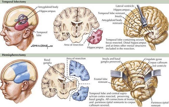 Epilepsy Clinical Gate
