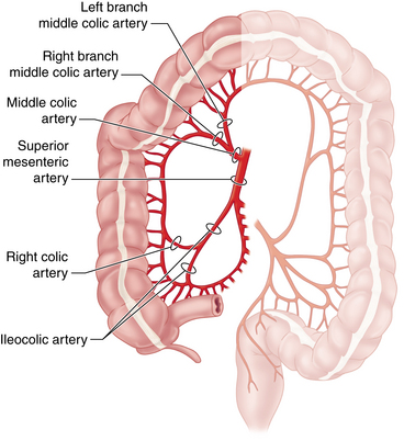Hand assisted Right Colectomy Clinical GateClinical Gate