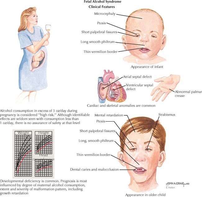 Fetal Alcohol Syndrome Clinical Gate