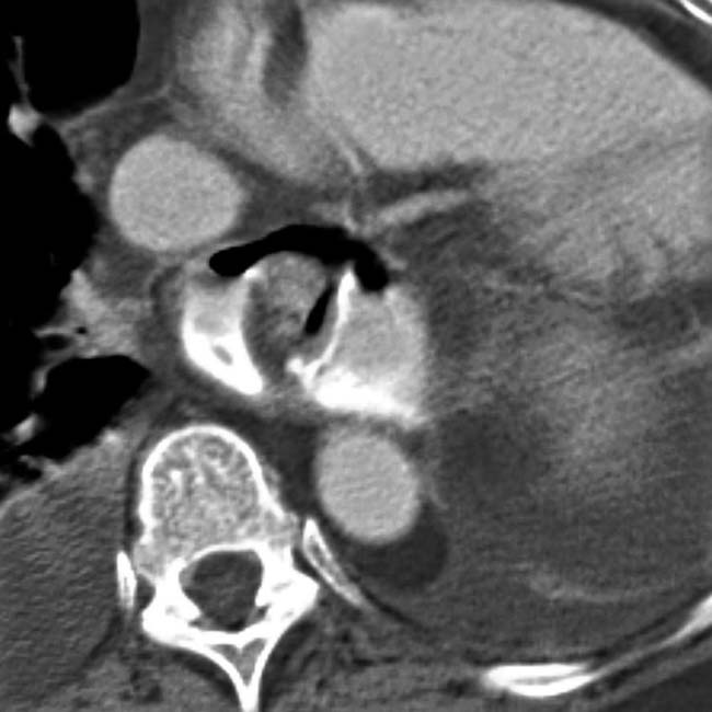 Fundoplication Complications Clinical Gate