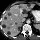 Biloma - Clinical GateClinical Gate